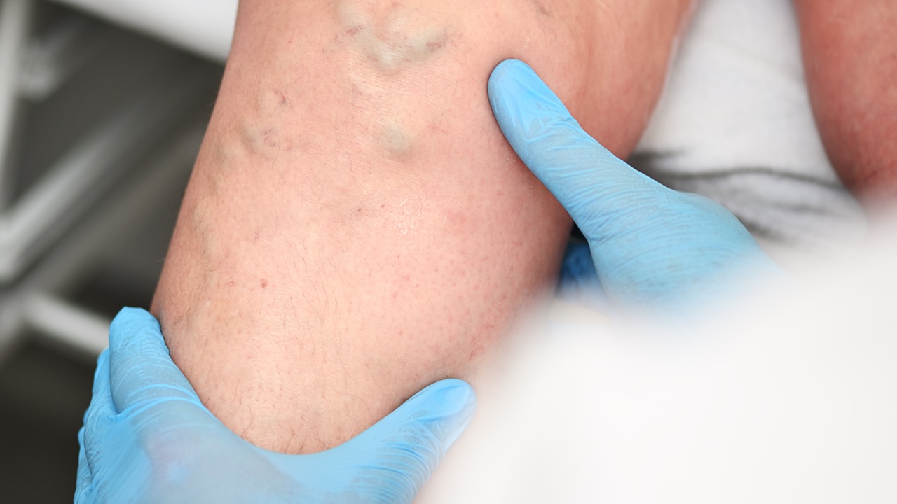 Healthy Veins: Tips for Improving Circulation While Working